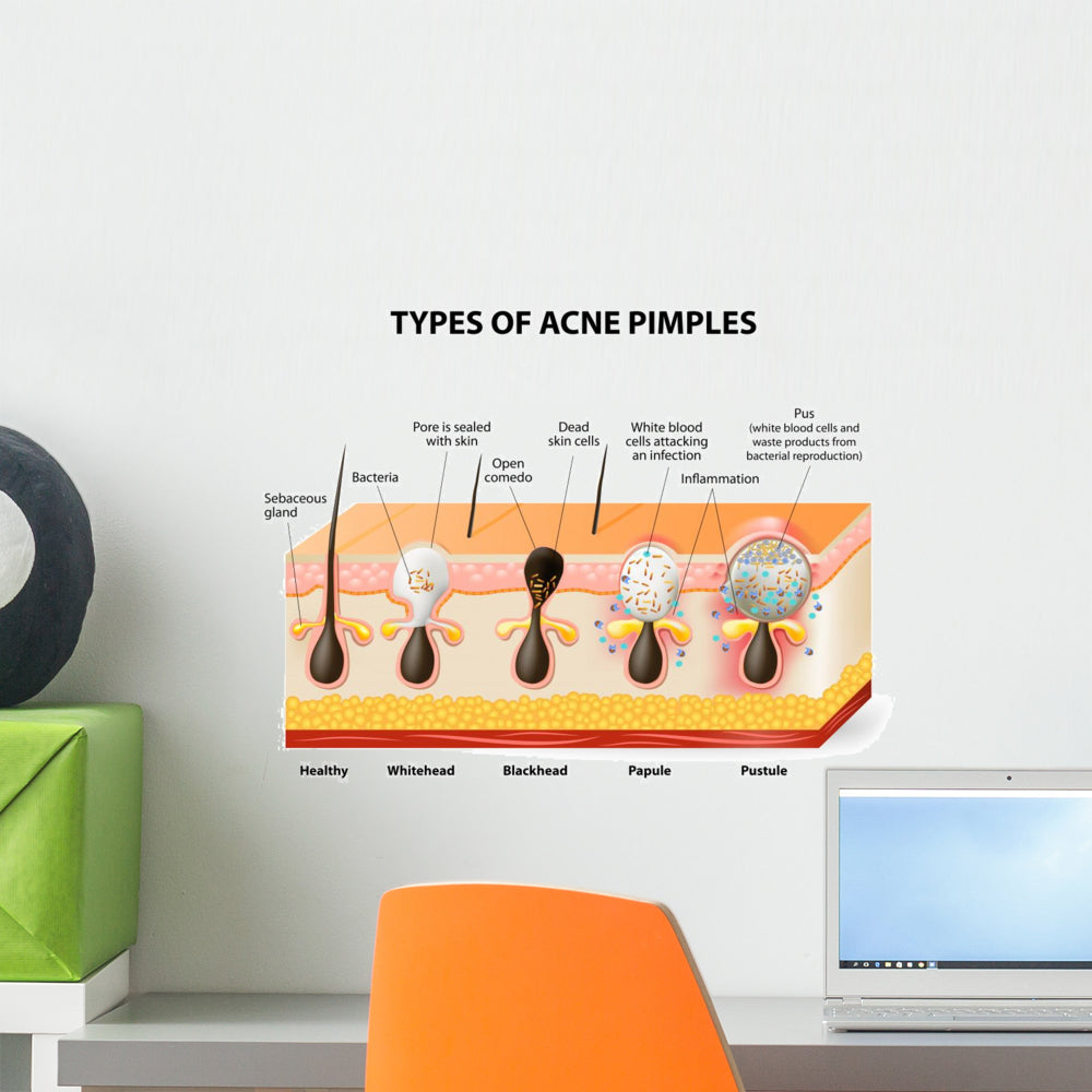 Acne Pimple Types Wall Decal - WallMonkeys.com – Wallmonkeys
